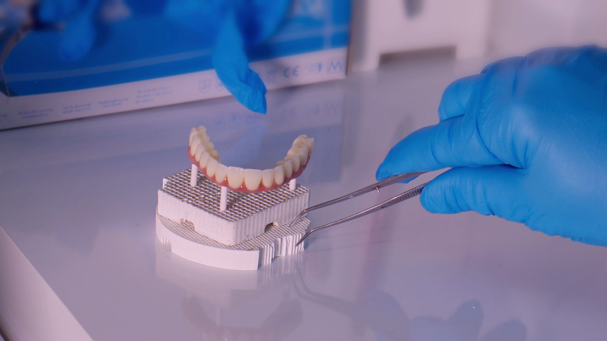 Zubný mostík Košice – riešenie chýbajúceho zuba | Denticon